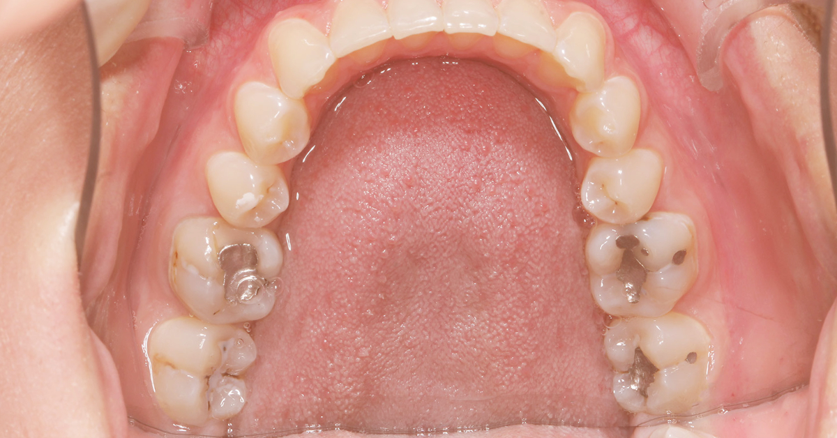 Amalgam fillings vs composite store
